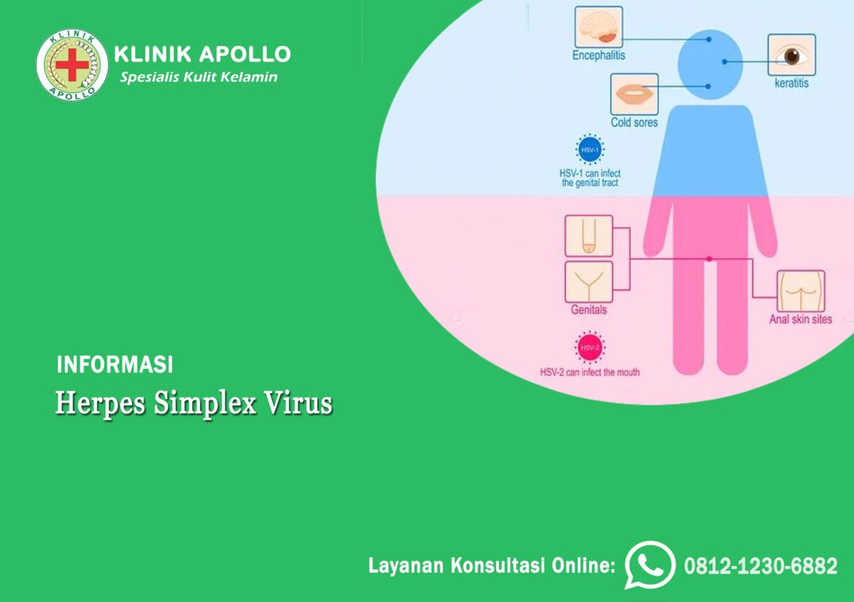 Herpes Simplex Virus: Penyebab Penyakit Herpes Genital | Klinik Apollo Jakarta