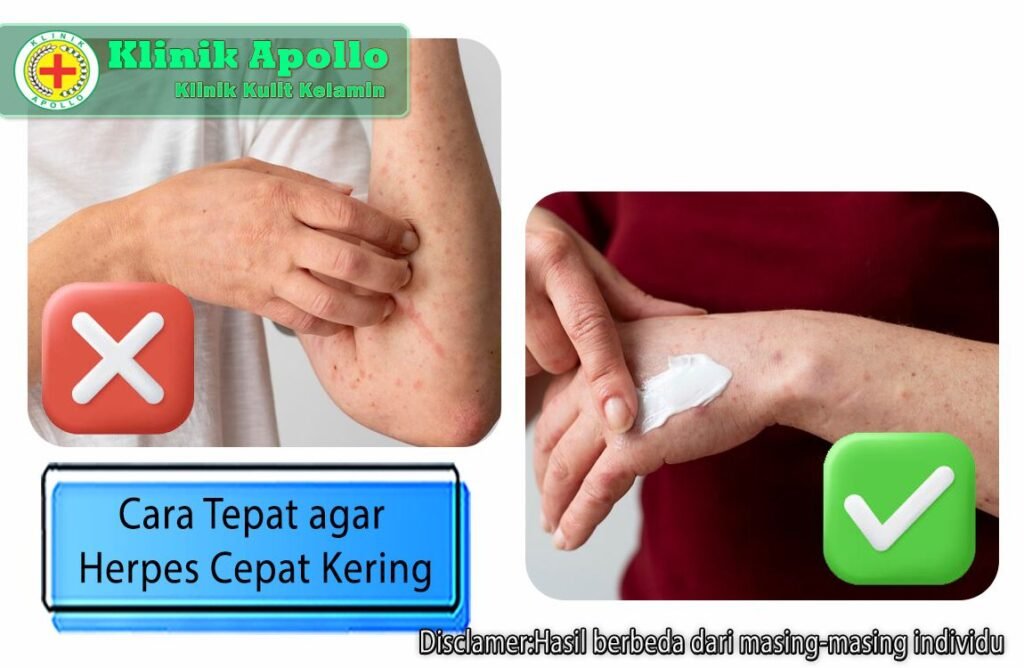 Agar Herpes Cepat Kering, Apa yang Harus Dilakukan? Simak | Klinik ...