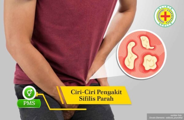 Waspada! 7 Ciri-ciri Penyakit Sifilis Parah Berikut Pengobatannya ...